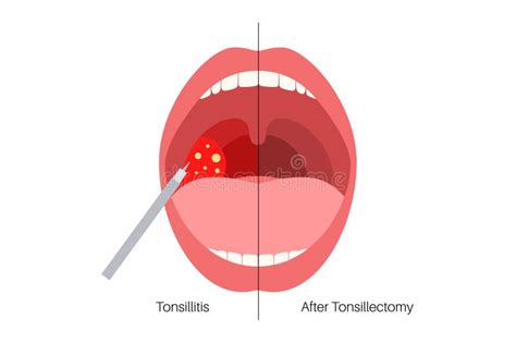 Tonsillectomy Procedure Poster Stock Vector Illustration Of Clinic Chronic 389652135