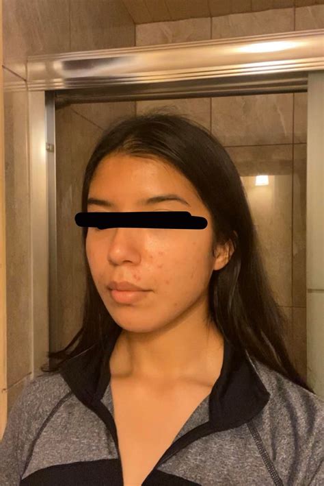 10 Months On Tretinoin Rtretinoin