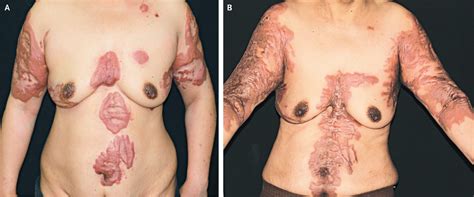 Keloidal Morphea Nejm
