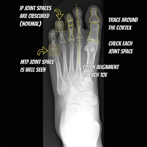 Toe Xray Labeled At William Jennings Blog