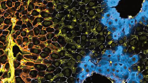 Spatial Proteomics Unravelling How Diseases Unfold In Tissues