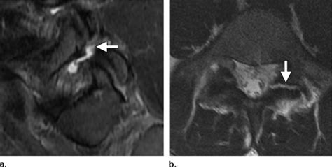 Stress Fractures Of The Pars Interarticularis In A 15 Year Old Female Download Scientific