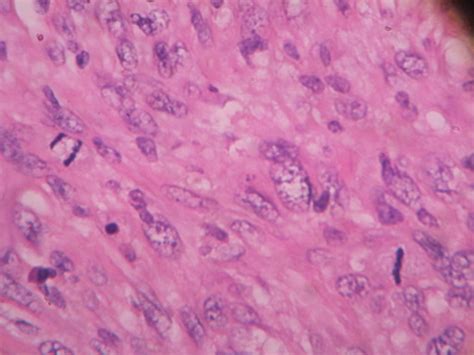 Gliosarcoma Atlas Histopathologyguru