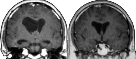 Neuroendoscopic Treatment Of Colloid Cysts Neupsy Key