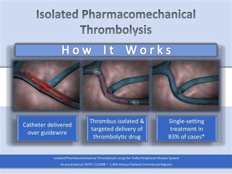 Catheter Directed Vs Systemic Thrombolysis At Steven Broadnax Blog