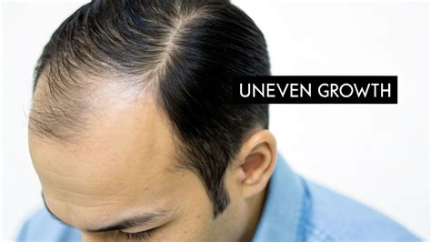 Uneven Hair Growth Causes And Treatments For Balanced Hair