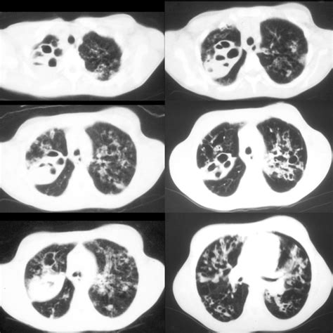 Pediatric Cystic Fibrosis Pediatric Radiology Reference Article Pediatric Imaging Pedsimaging