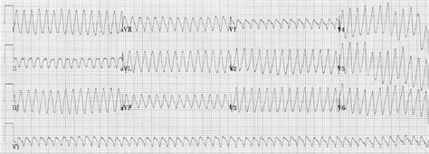 Ventricular Flutter LITFL ECG Library Diagnosis