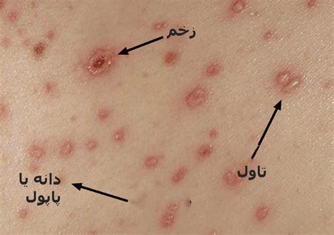 علائم آبله میمونی چه تفاوتی با آبله مرغان دارد؟ عکس