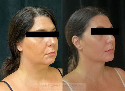 Submental Liposuction Before And After Pictures Case 345 Boston Ma