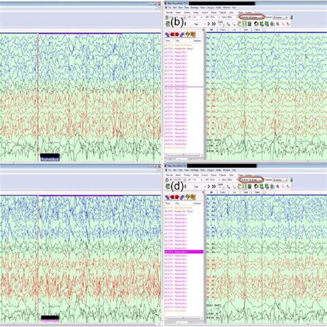 Quantitative Eeg Analysis A Before The Iv Methylprednisolone Download Scientific Diagram