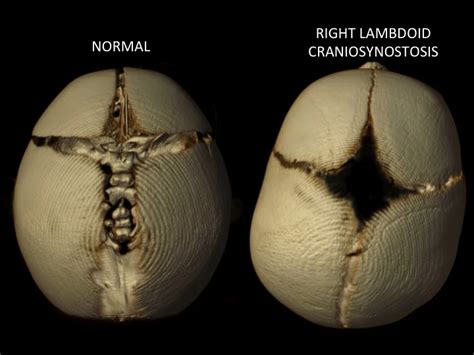 Lambdoid Synostosis — Dallas Pediatric Plastic Surgeon Craniofacial Surgeon Cleft Lip And