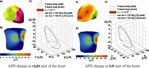 Vectocardiographic Representation Of The Discordant T Wave Alternans In