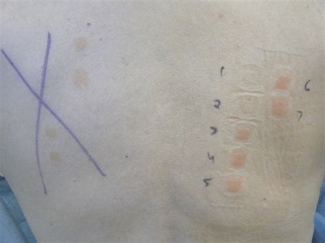 Patch Testing To Dcp After Repeat Sensitization The Right Side Download Scientific Diagram