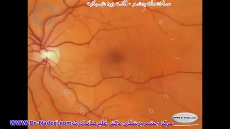 لکه زرد شبکیه چشم یا ماکولا مرکز چشم پزشکی دکتر علیرضا نادری نماشا