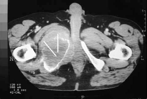 Ct Showing Lytic Lesion Of The Right Ischium Download Scientific Diagram