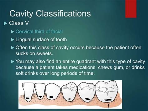 Dental Charting Cavity Classification Basic Charting Terms Pptx