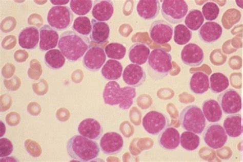 Leukemia Flashcards Quizlet