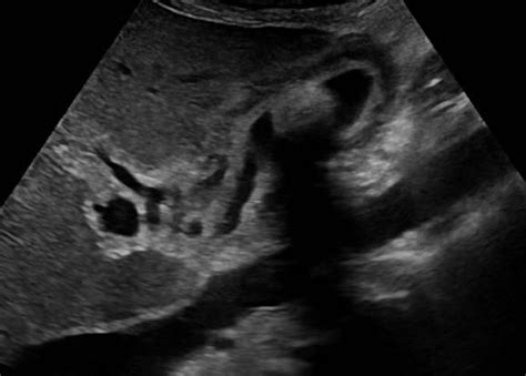 Abdomen And Retroperitoneum 12 Gallbladder And Bile Ducts Case 12