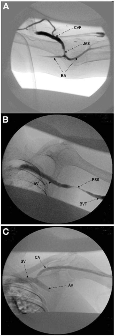 Frequency Of Swing Segment Stenosis In Referred Dialysis Patients With Angiographically