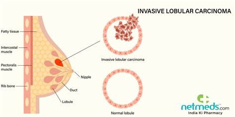 Invasive Lobular Carcinoma Causes Symptoms And Treatment