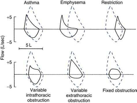 Restrictive Lung Disease Flow Volume Loop Quotes Home