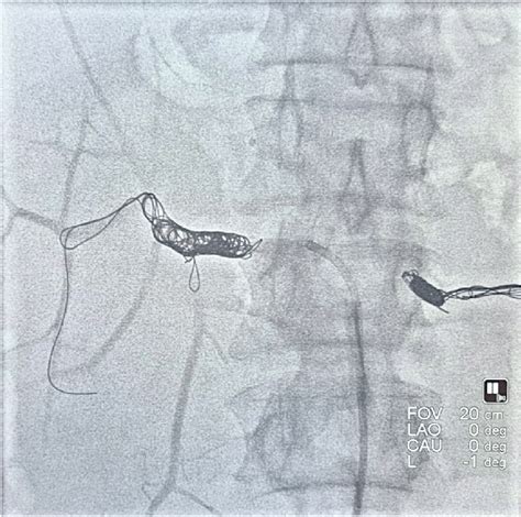 Radiographic Image Showing Bilateral Embolization Of Renal Arteries Download Scientific Diagram
