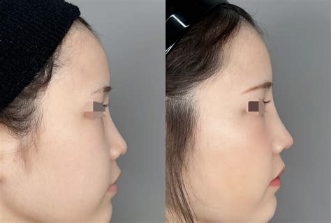 鼻尖形成とは？鼻の手術について解説！ 【公式】astra Beauty Clinic（アストラビューティクリニック）｜美容外科・美容皮膚科
