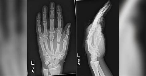 Metacarpal Head Fracture