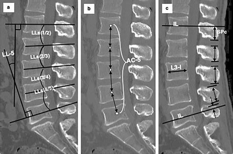 Definitions Of L1 L5 Parameters In Mid Sagittal Computed Tomography