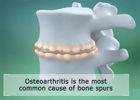 Bone Spur ️ Orlando Medical Center