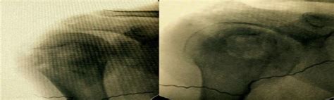 Chondroblastoma Of Proximal Humerus Case Report And Review Journal Of Integrated Health