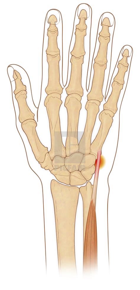 Extensor Carpi Ulnaris Tenosynovitis