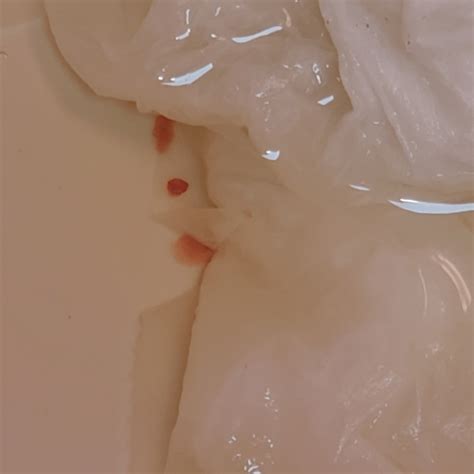 My Experience Prolapsed Fibroid Hysteroscopic Myomectomy Dandc And