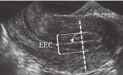 Endometrial Echo Complex Eec Measurement In The Sagittal Plane Download Scientific Diagram