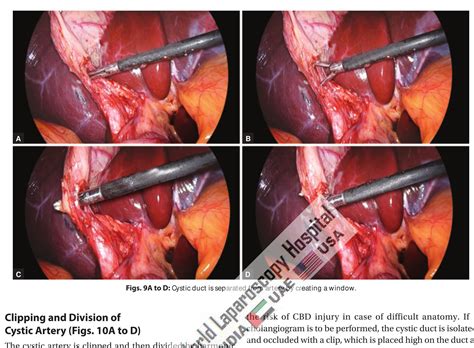 Figure 6 Laparoscopic Cholecystectomy