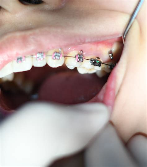 Metal Braces Cardiff Birchgrove Dental Practice