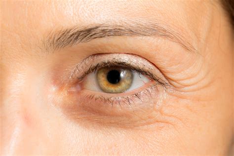 Crows Feet And Bags Under Eyes At Mary Langan Blog