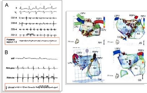 Electrogram Guided Complex Fractionated Atrial Electrogram Cfae Download Scientific Diagram