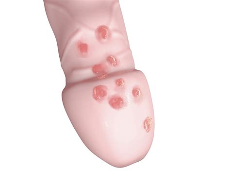 Bumps On Penis What Causes And What To Do