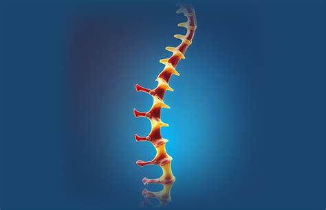 Understanding S Shaped Scoliosis In Depth Analysis Treating Scoliosis