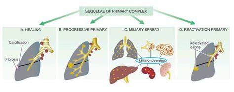 Primary Complex Tuberculosis Medizzy
