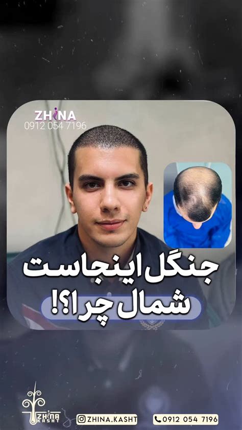 ‎کاشت ژینا زیر نظر پزشک متخصص پوست و مو‎ ‎ ️تو هم جنگل میخوای؟ جنگلو