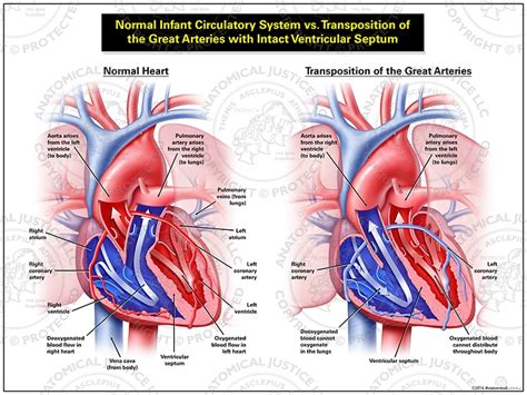 Normal Circulatory System Vs Transposition Of The Great Arteries