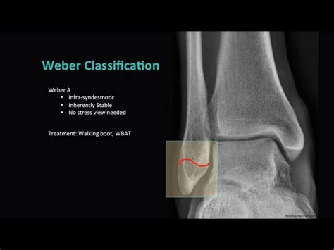 Distal Fibula Fracture Recovery Time Is This Kind Of Distal Fibula