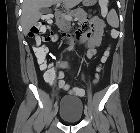 Stump Appendicitis Clinical And Ct Findings Ajr