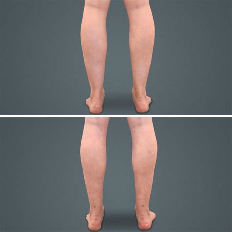 Calf And Ankle Liposuction Sydney Gold Coast Canberra Adelaide