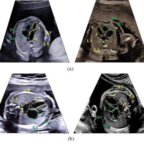 pdf automatic detection of cardiac chambers using an attention based yolov4 framework from