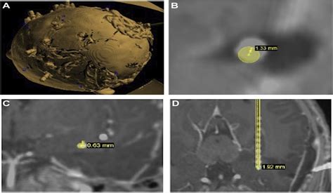 Operative Neurosurgery