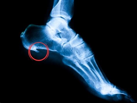 Heel Spur Surgery Recovery Time